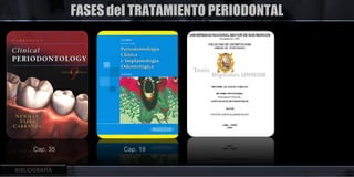 Fases del tratamiento periodontal | PPTX