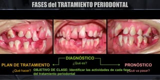 Fases del tratamiento periodontal | PPTX