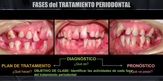 Fases del tratamiento periodontal | PPTX