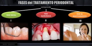 Fases del tratamiento periodontal | PPTX