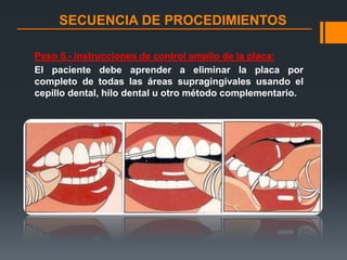 Fases del tratamiento periodontal, Carranza, Periodontología clínica ...