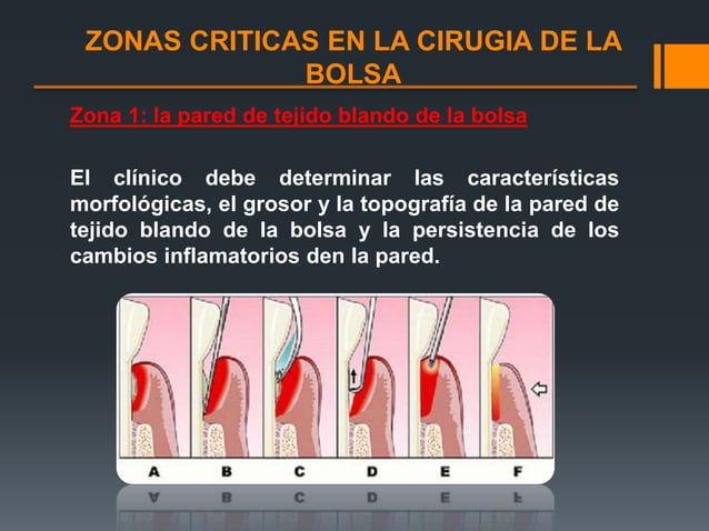 Fases del tratamiento periodontal, Carranza, Periodontología clínica, Décima edicion | PPTX