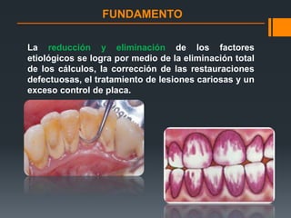 Fases del tratamiento periodontal, Carranza, Periodontología clínica ...