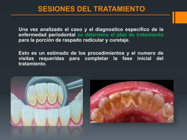 Fases del tratamiento periodontal, Carranza, Periodontología clínica ...
