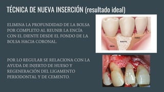 Fases del tratamiento periodontal | PDF