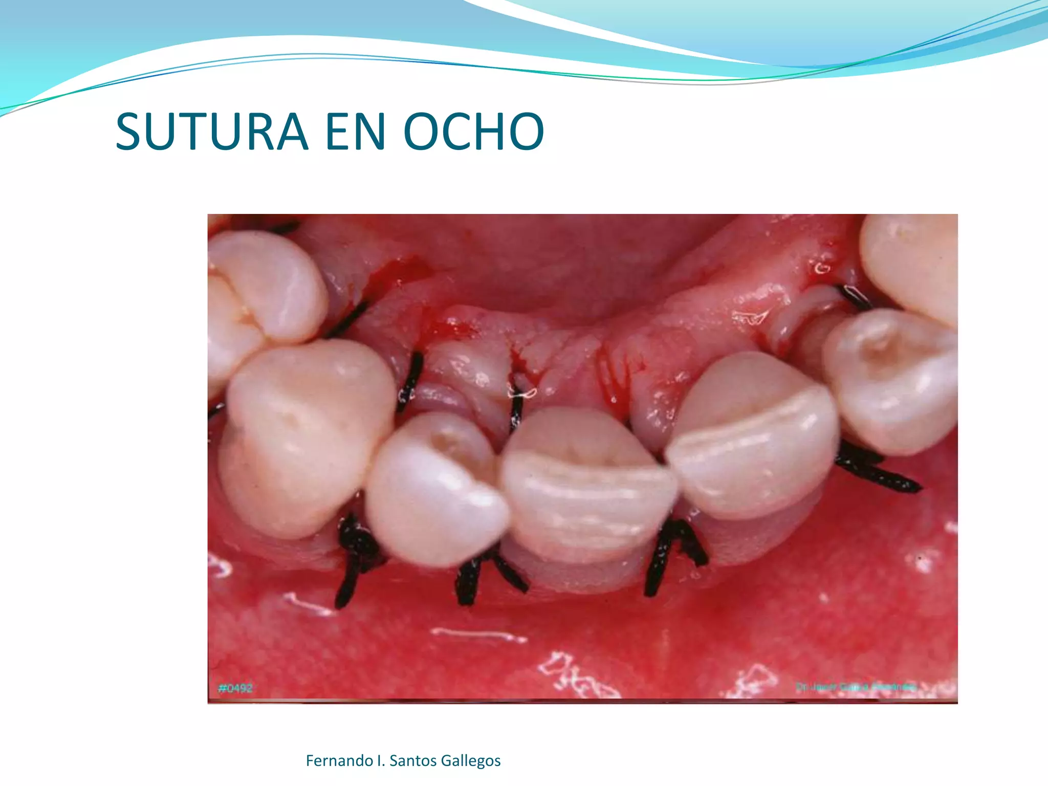 Fases De Tratamiento Periodontal