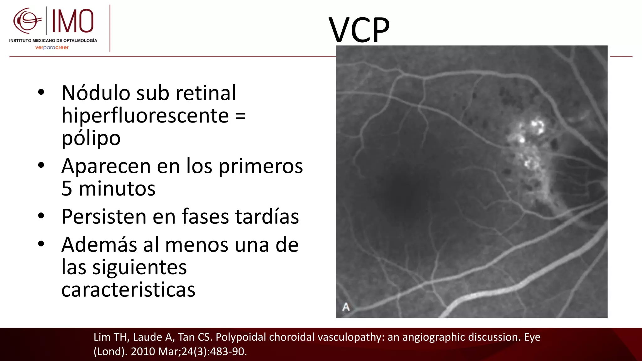Angiografia con Verde de indocianina: Fases y patrones en VCP ...