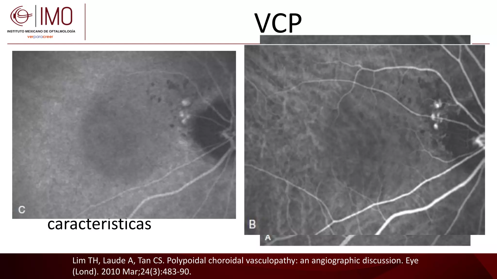 Angiografia con Verde de indocianina: Fases y patrones en VCP ...