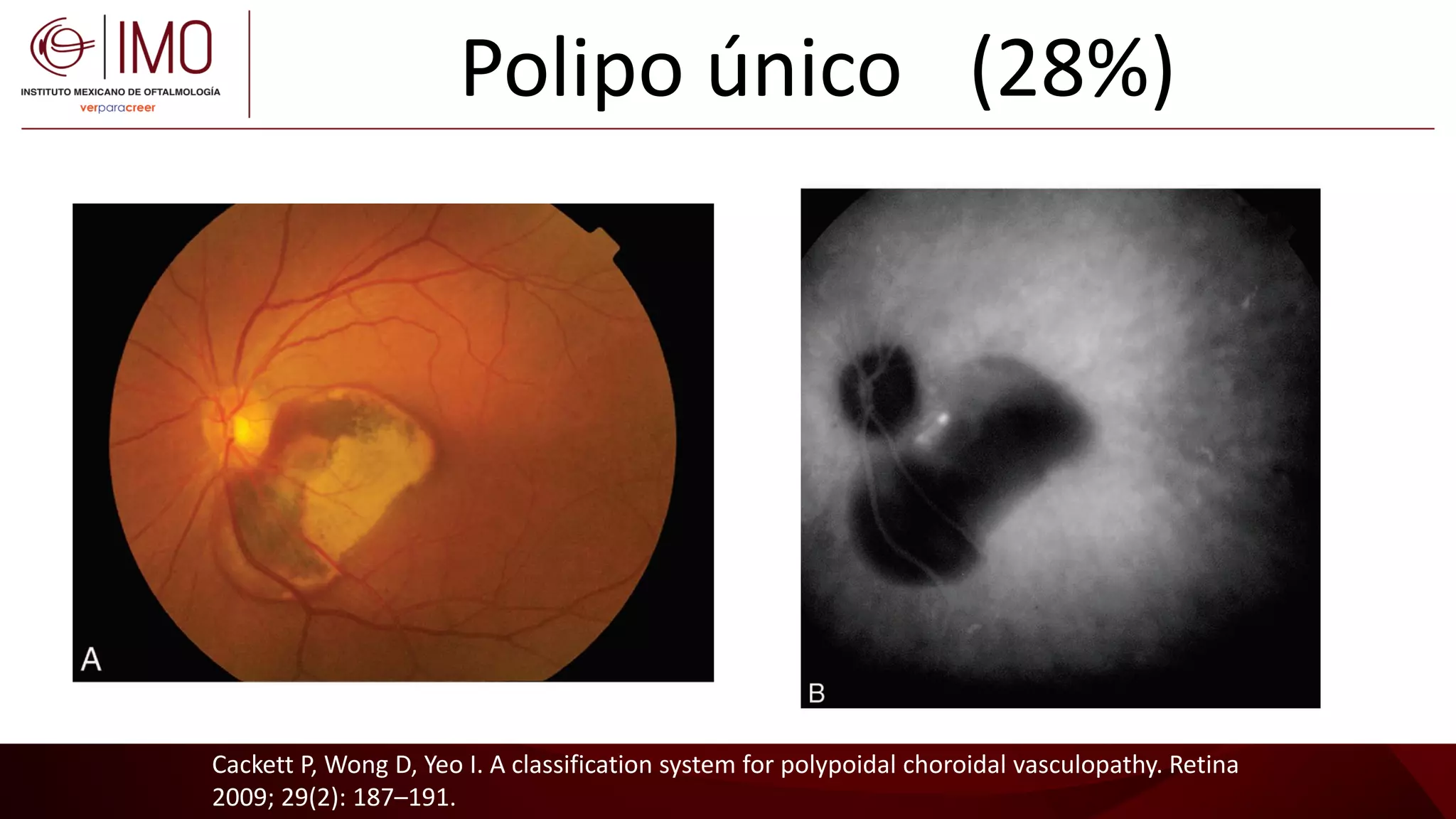 Angiografia con Verde de indocianina: Fases y patrones en VCP ...