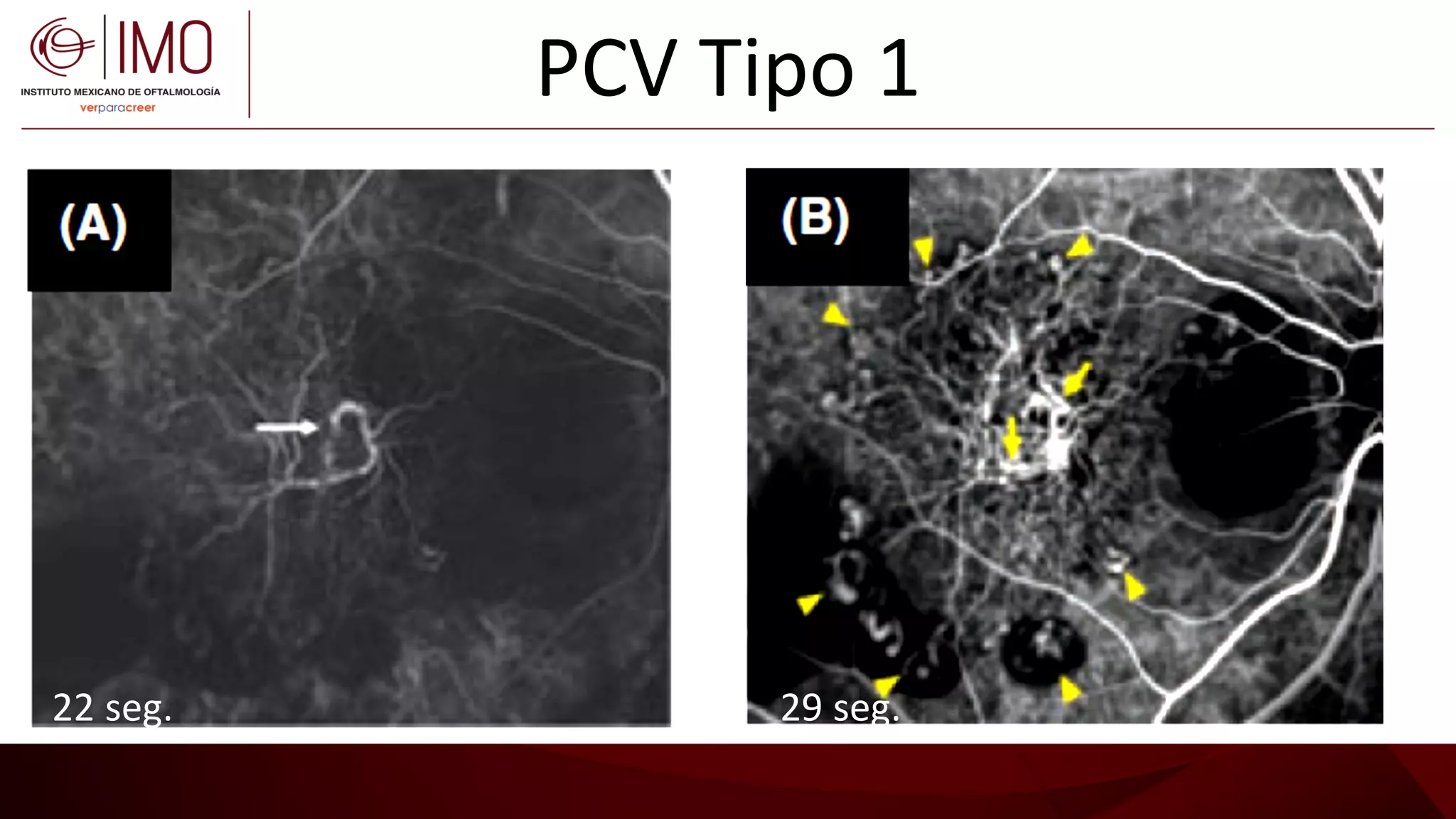 Angiografia con Verde de indocianina: Fases y patrones en VCP ...