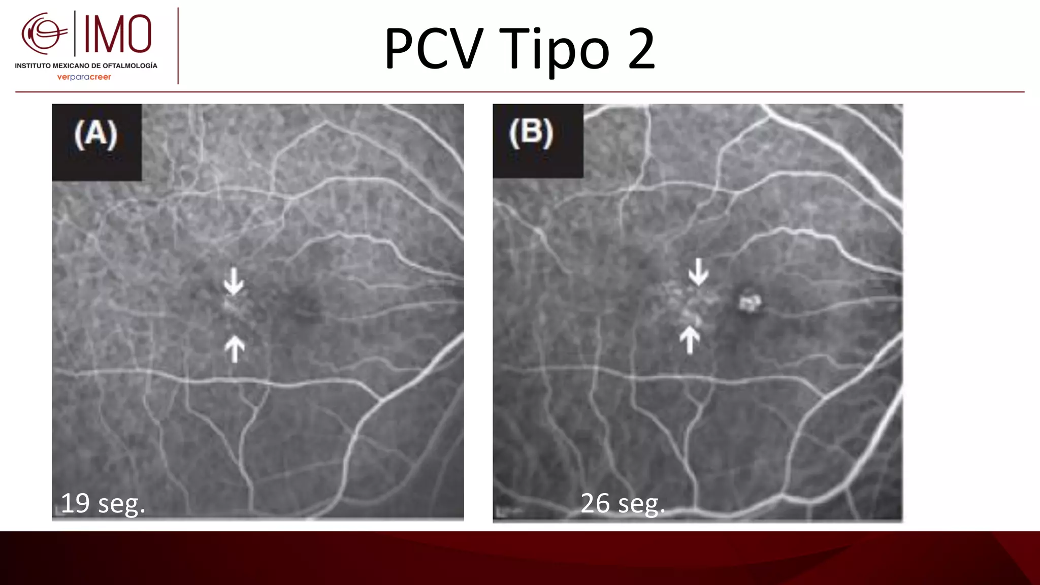 Angiografia con Verde de indocianina: Fases y patrones en VCP ...
