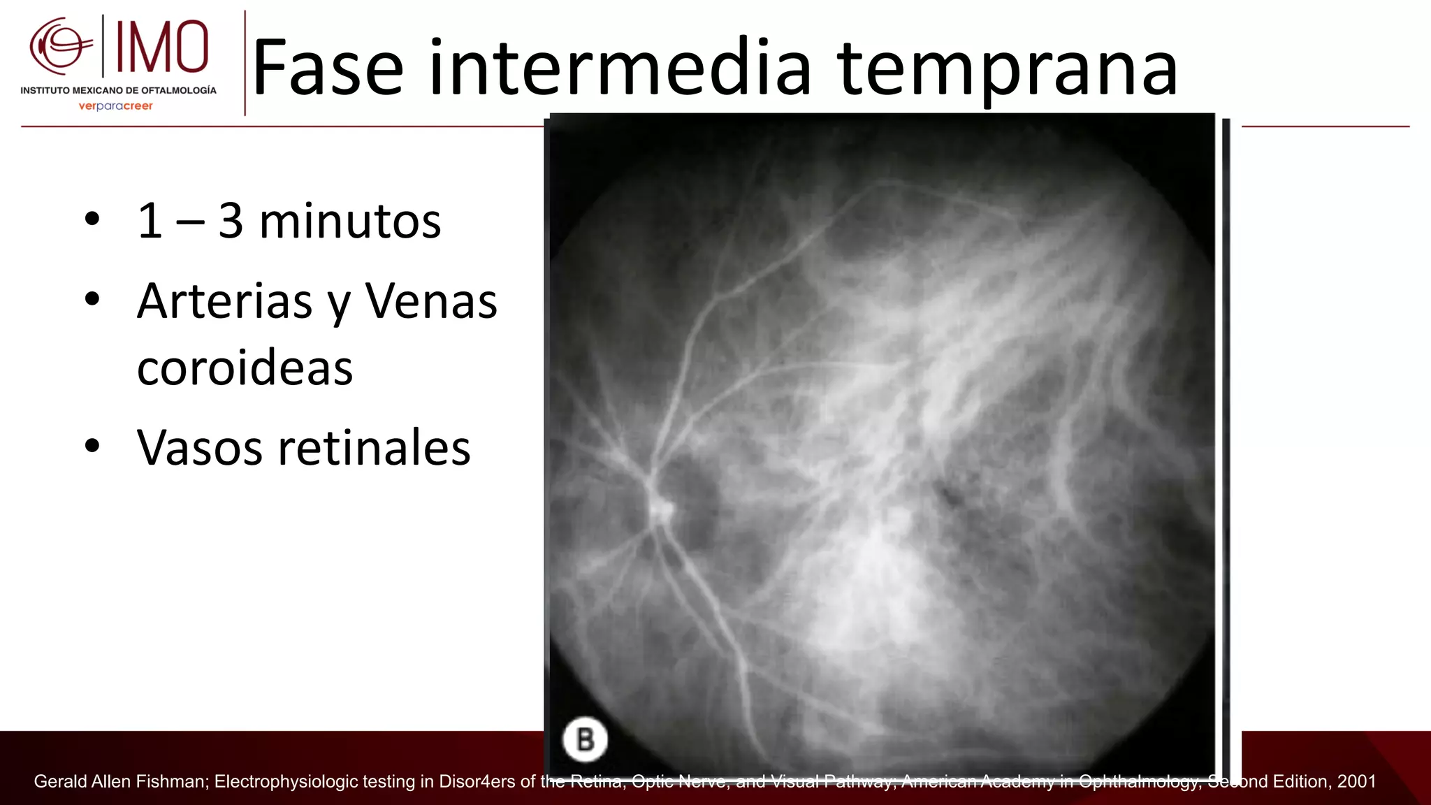 Angiografia con Verde de indocianina: Fases y patrones en VCP ...