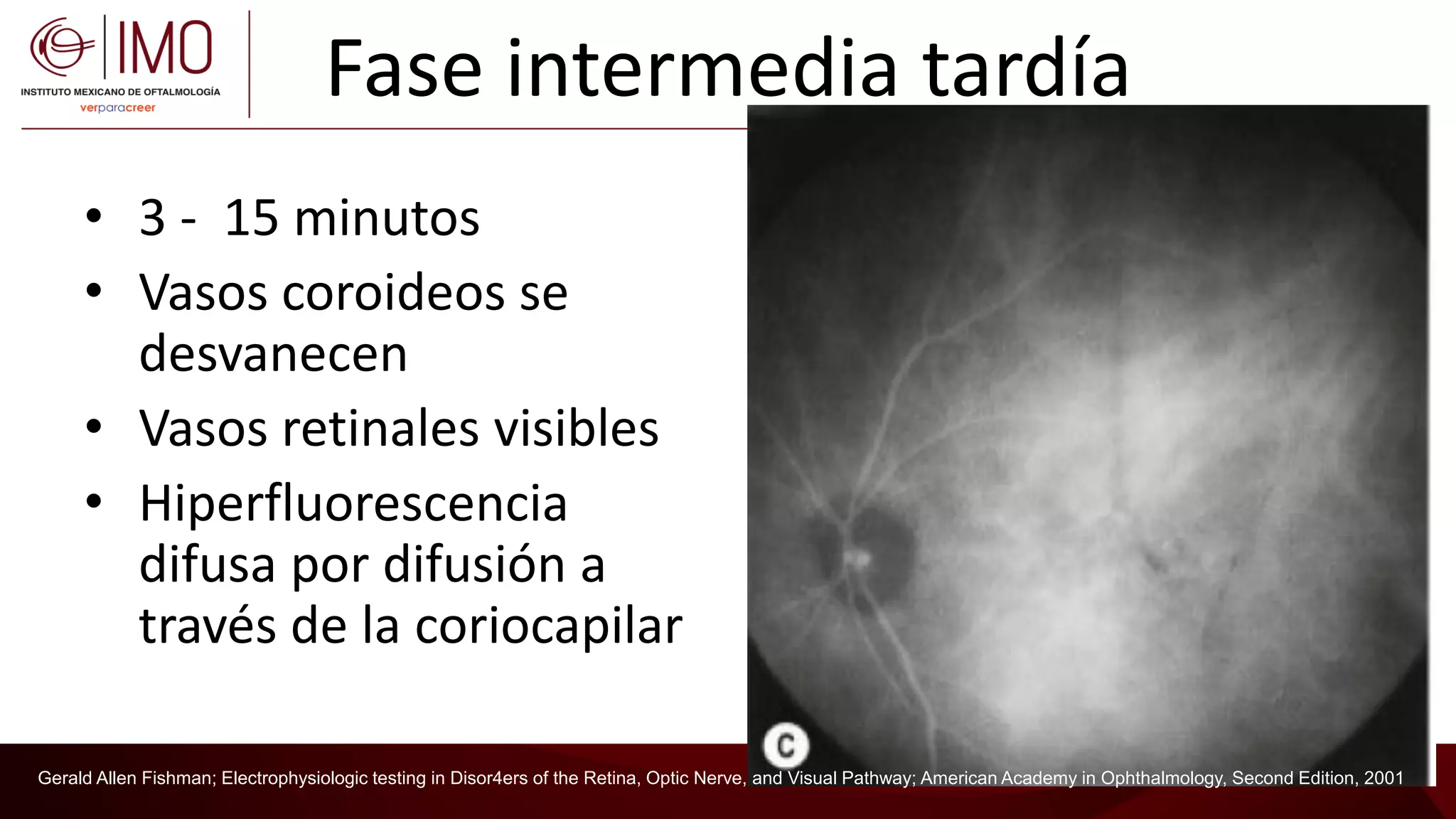Angiografia con Verde de indocianina: Fases y patrones en VCP ...