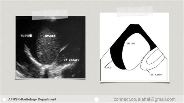 focused assessment with sonography for trauma | PDF