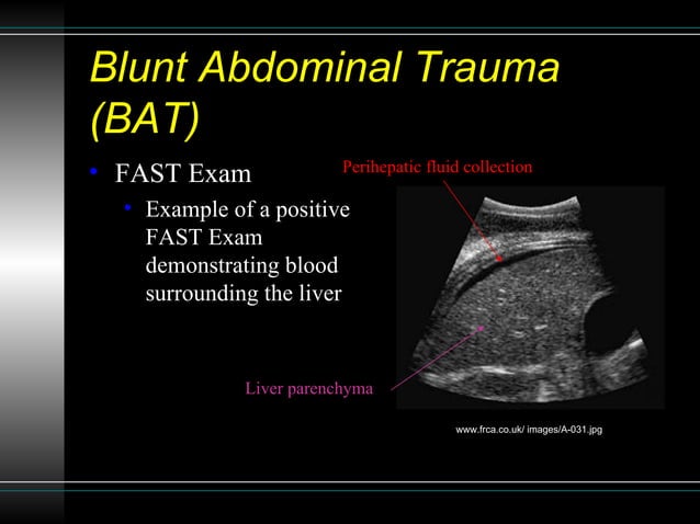 Sonographic Assessment of Blunt Abdominal Trauma in the Emergency ...