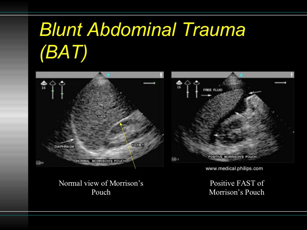 Sonographic Assessment of Blunt Abdominal Trauma in the Emergency Dep…