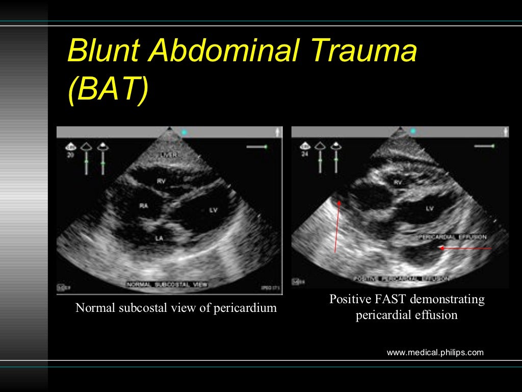 Sonographic Assessment of Blunt Abdominal Trauma in the Emergency Dep…