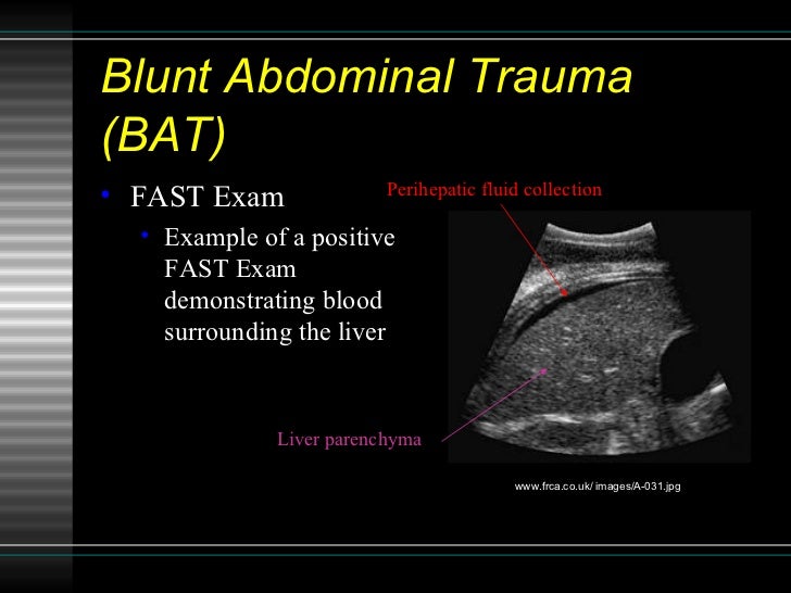 Sonographic Assessment of Blunt Abdominal Trauma in the Emergency Dep…