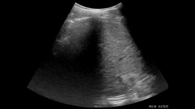 FAST scan in STABLE BLUNT TRAUMA patients | PPTX