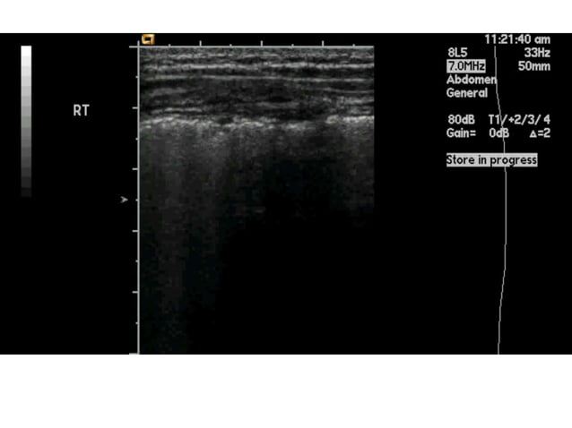 Focused Assessment with Sonography in Trauma (FAST) in 2017 | PPTX