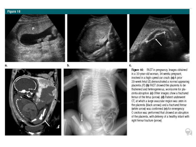 Focused Assessment with Sonography in Trauma (FAST) in 2017 | PPTX