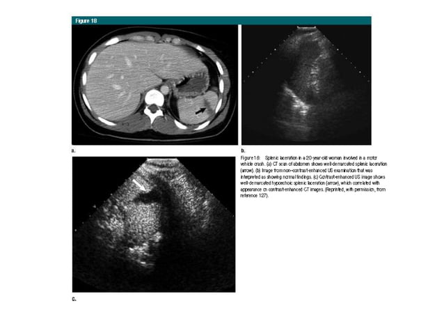 Focused Assessment with Sonography in Trauma (FAST) in 2017 | PPTX
