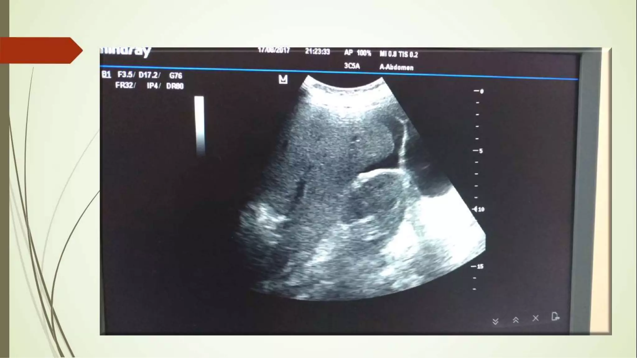 FAST EN TRAUMA ABDOMINAL | PPT