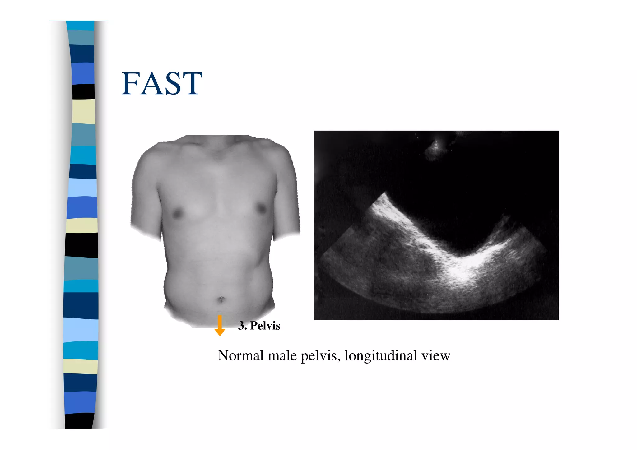Focused Abdominal Sonography for Trauma | PDF
