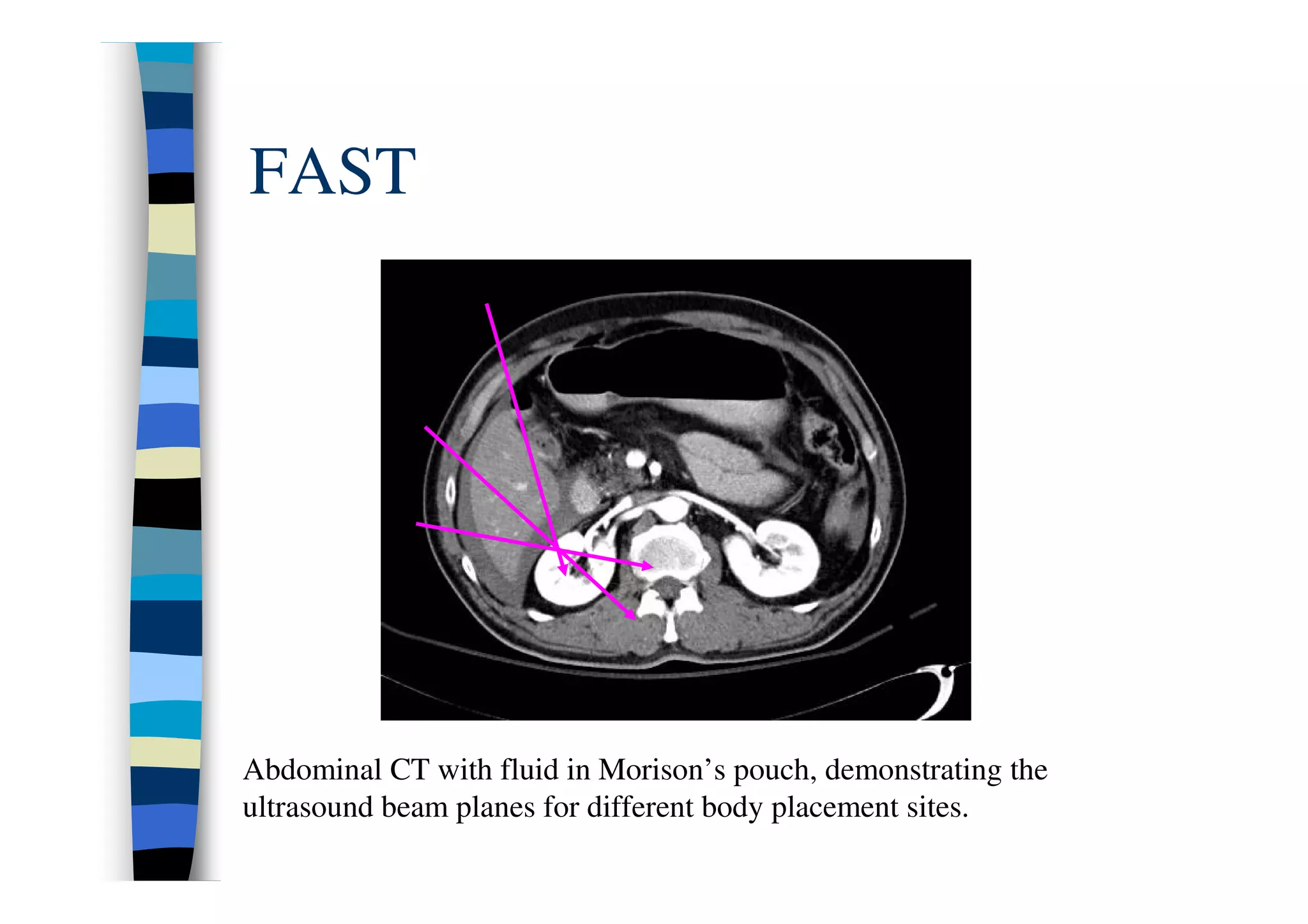 Focused Abdominal Sonography for Trauma | PDF