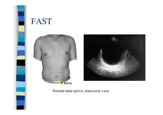 Focused Abdominal Sonography for Trauma | PDF