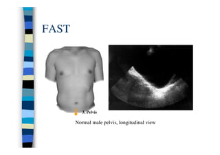 Focused Abdominal Sonography for Trauma | PDF