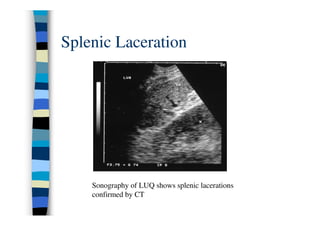 Focused Abdominal Sonography for Trauma | PDF