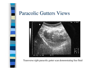 Focused Abdominal Sonography for Trauma | PDF