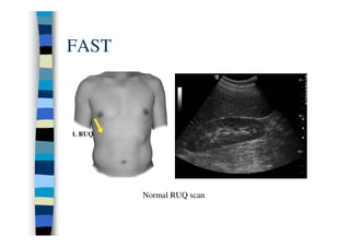 Focused Abdominal Sonography for Trauma | PDF