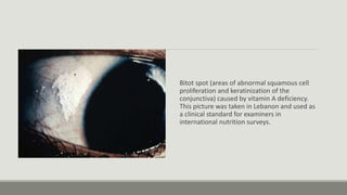 Fat -soluble vitamins.pptx