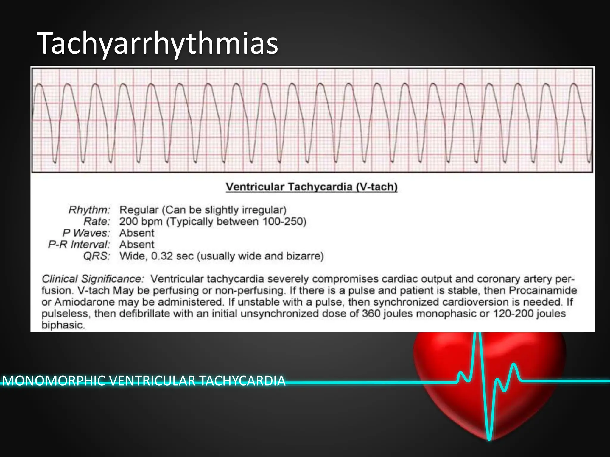 Fatal-Arrhythmias by henry ligutum (Northern Mindanao Medical Center ...