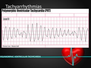 Fatal-Arrhythmias by henry ligutum (Northern Mindanao Medical Center ...