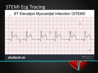 Fatal-Arrhythmias by henry ligutum (Northern Mindanao Medical Center) | PPT