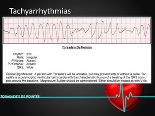 Fatal-Arrhythmias by henry ligutum (Northern Mindanao Medical Center) | PPT