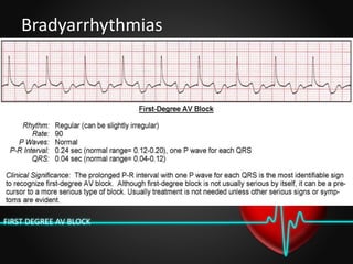 Fatal-Arrhythmias by henry ligutum (Northern Mindanao Medical Center) | PPT