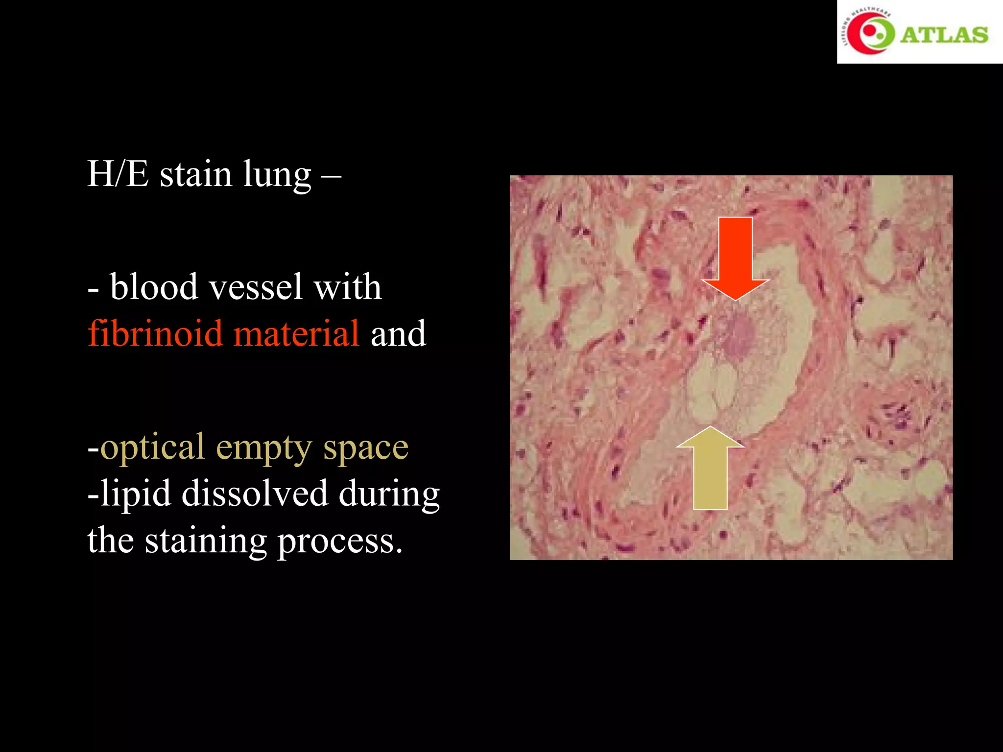 Fat embolism | PPT