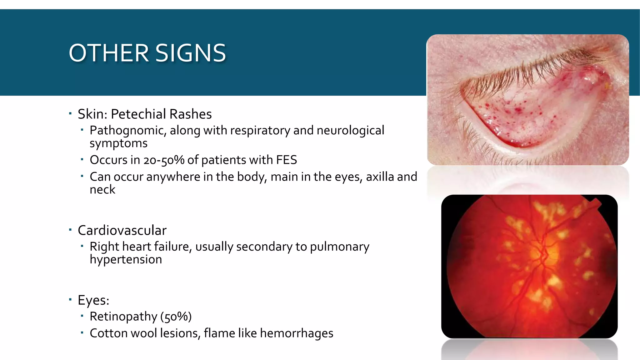 Fat embolism Syndrome | PPTX