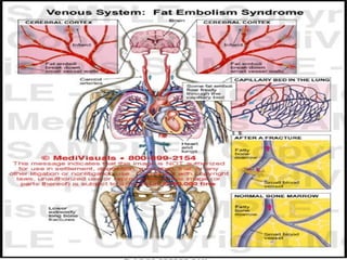 Fat embolism (by anurag mittal) | PPT