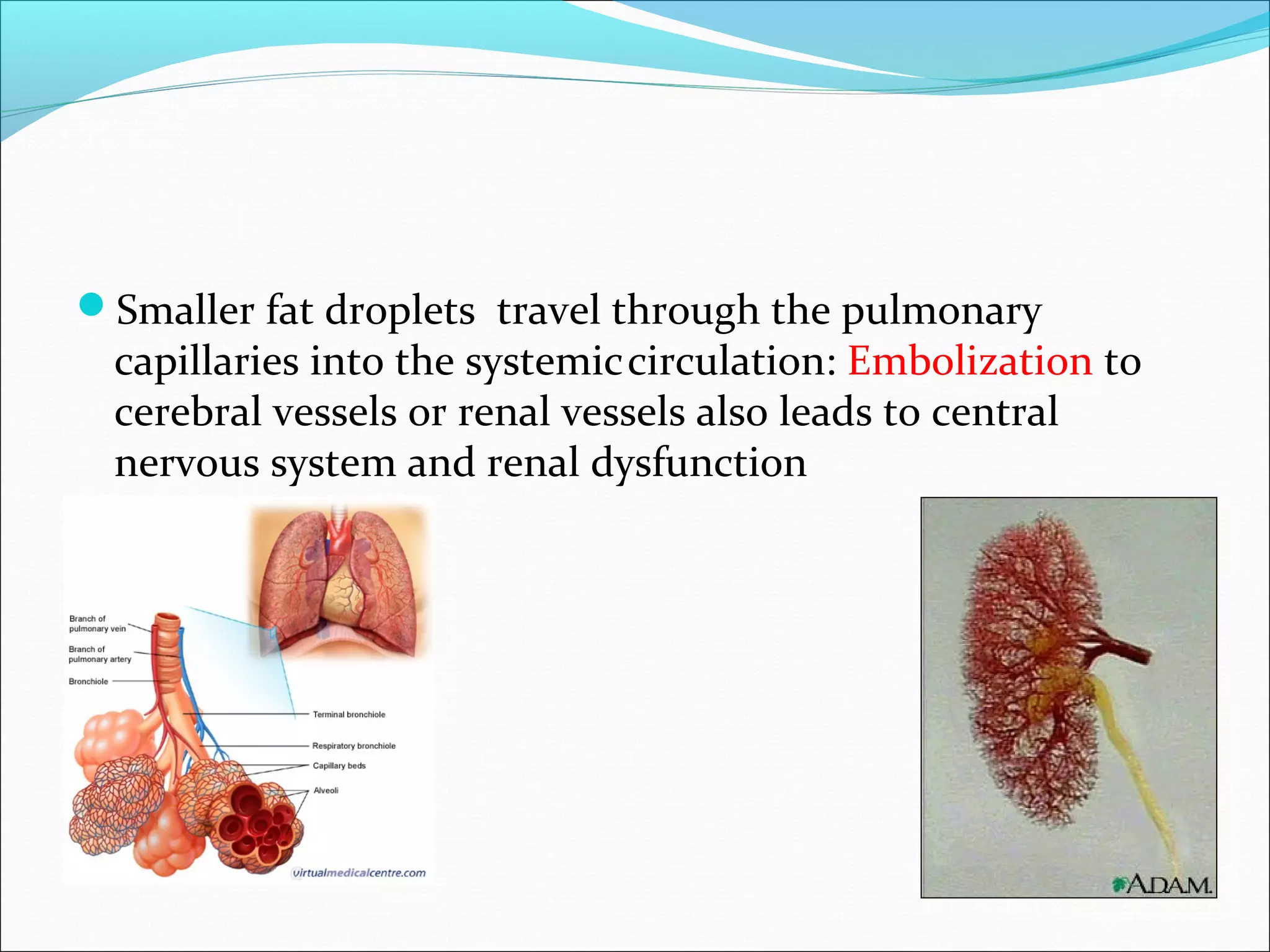 Fat embolism syndrome | PPT