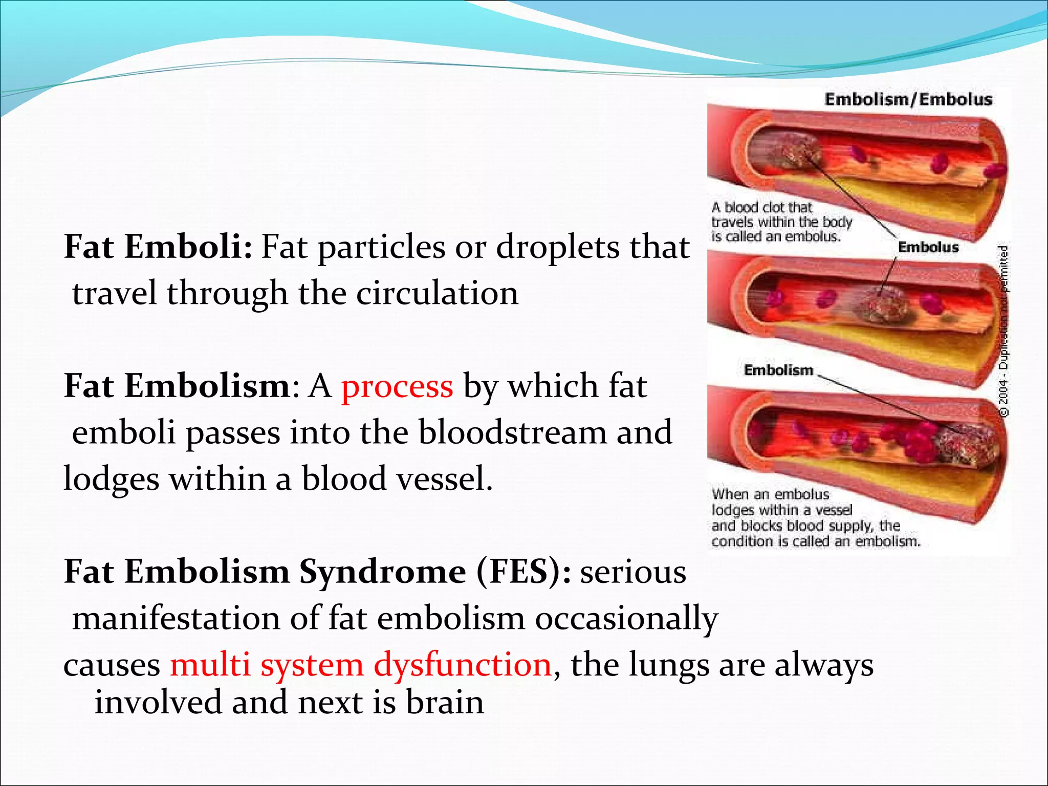Fat embolism syndrome | PPT