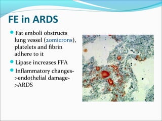 Fat embolism syndrome | PPT