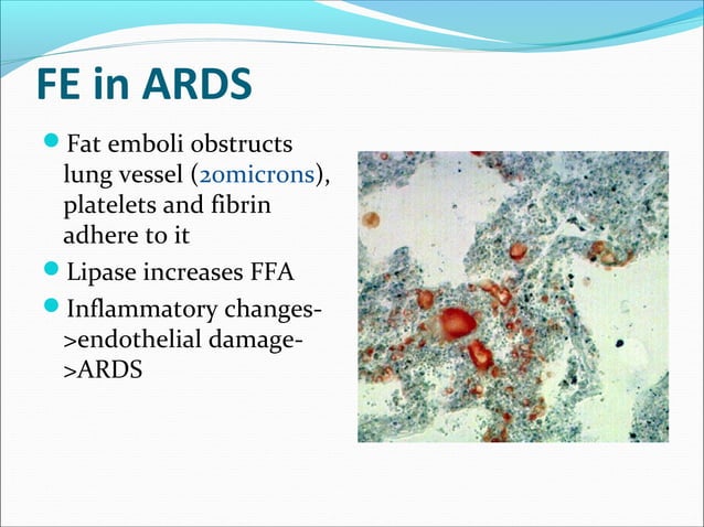 Fat embolism syndrome | PPT | Bone and Joint Conditions | Diseases and ...