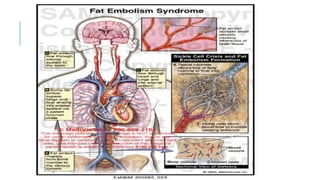 Fat embolism syndrome | PPTX
