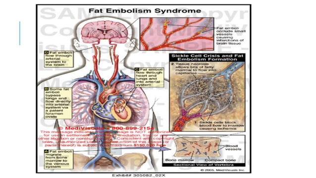 Fat embolism syndrome | PPTX | Bone and Joint Conditions | Diseases and ...