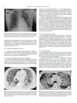 Fat embolism syndrome state of-the-art review focused on | PDF